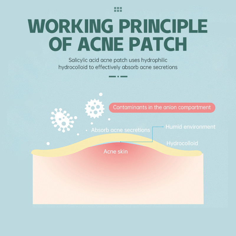 36PCS/Sheet Acne Pimple Patch Salicylic Acid Acne Treatment Stickers ...