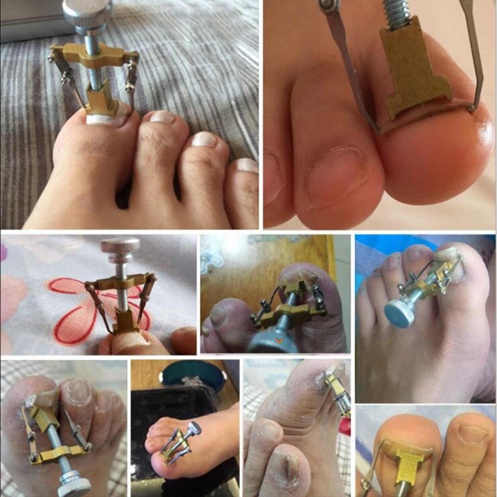 Ingrown Toe Nail Fixer Pedicure Toenail Recover Nail Correction Tool ...