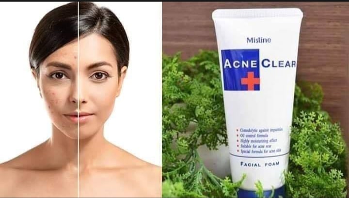 MISTINE ACNE CLEAR FACIAL FOAM 85G - Face Wash(Made in Thiland) | Daraz.com.bd