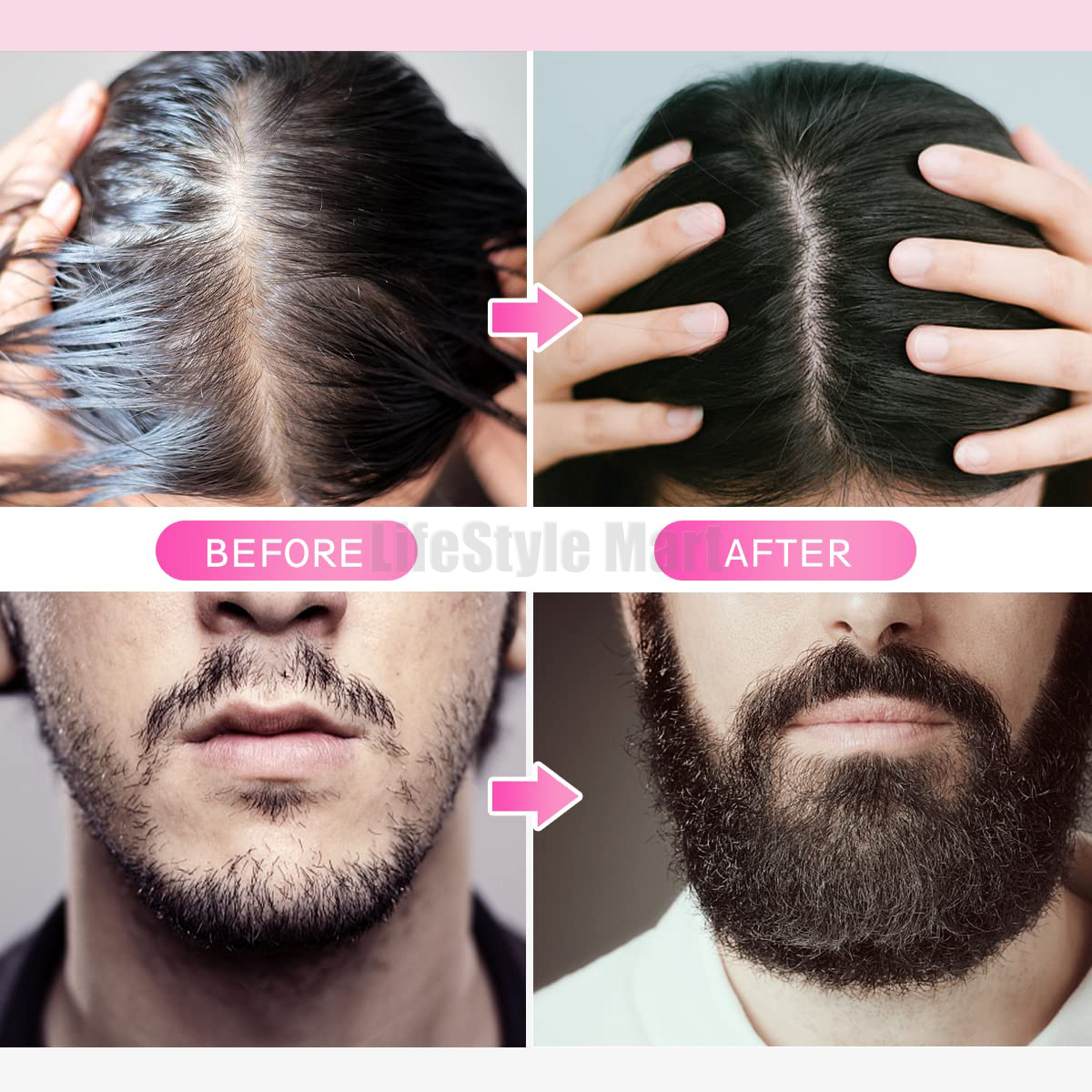 1.5MM Derma Roller Beard hair Growth Kit Microneedle Roller for Hair ...